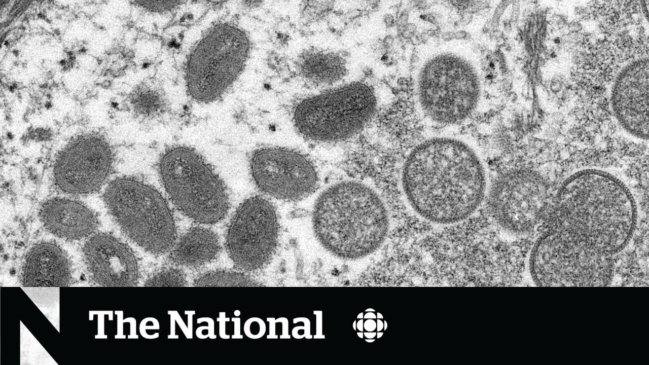 Monkeypox cases, transmission under investigation in Canada - YouTube