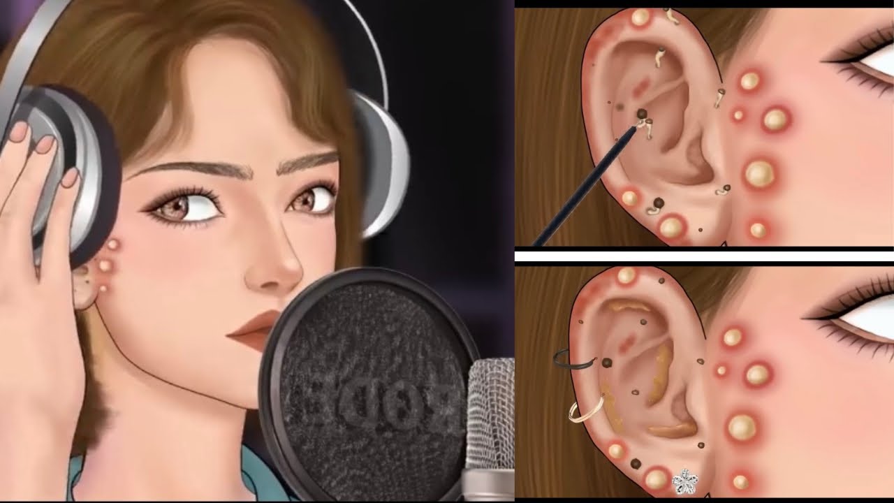 ASMR Pimple blackhead and sebaceous cystremoval for famous singer ...