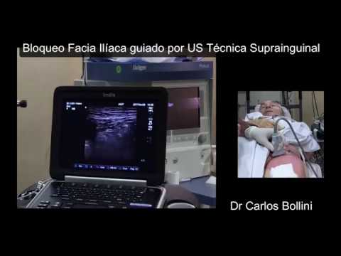 Bloqueo Fascia Iliaca Suprainguinal guiado por Ultrasonografía - YouTube