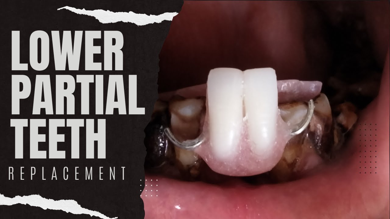 Lower partial denture with Claps | Removable partial denture front ...