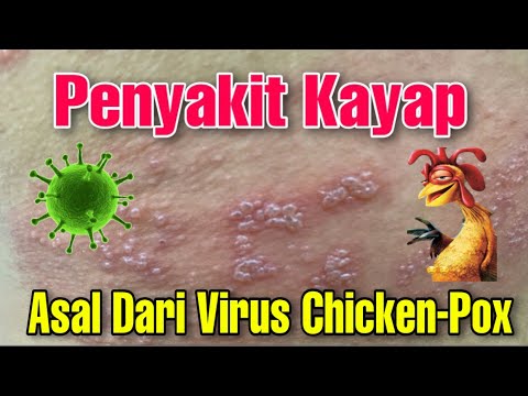 KAYAP BERASAL DARI VIRUS CHICKEN POX - @DrManTtdi - YouTube