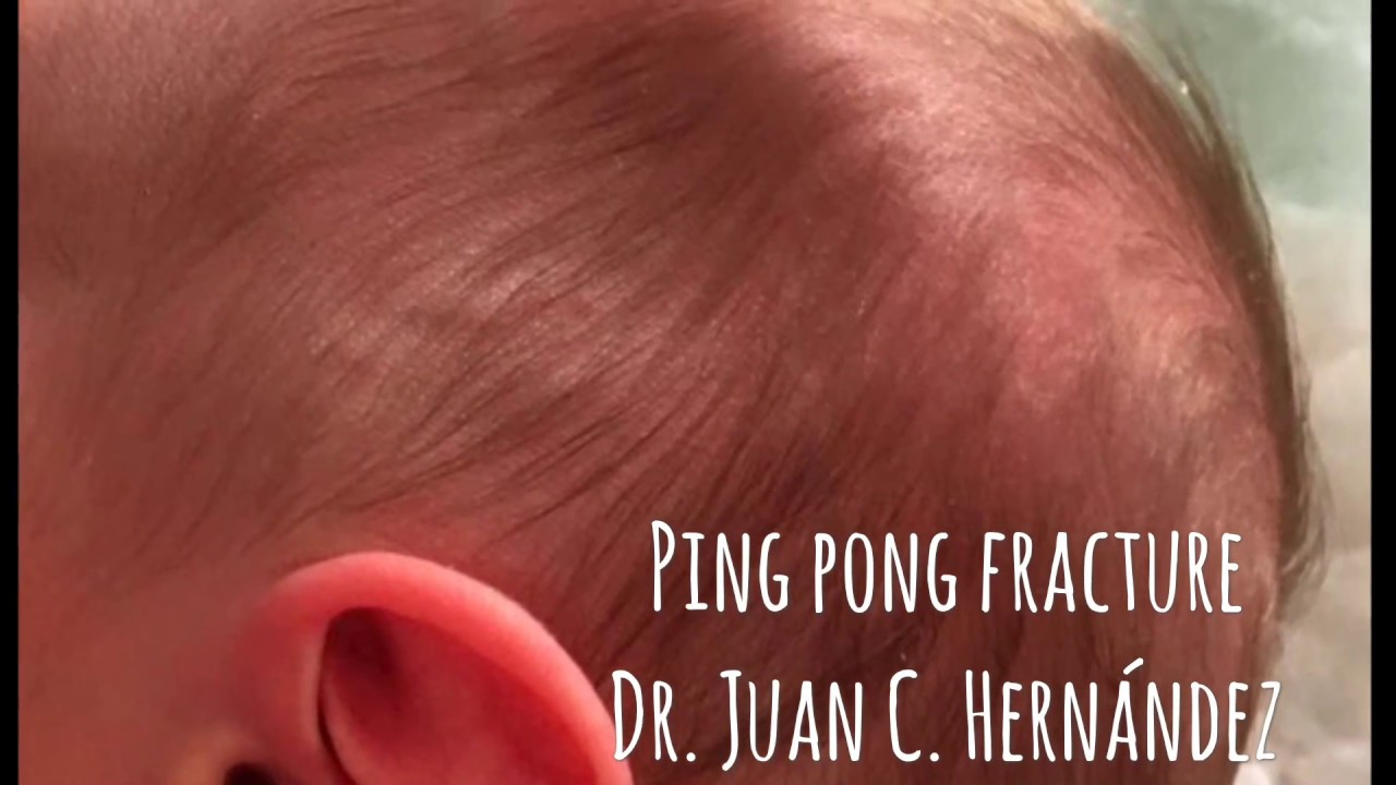 Ping pong fracture - YouTube