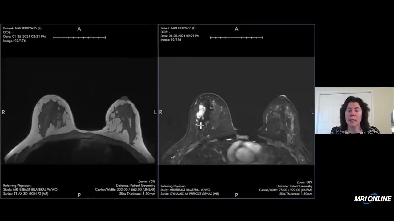Breast MRI: BI-RADS Assessment - YouTube