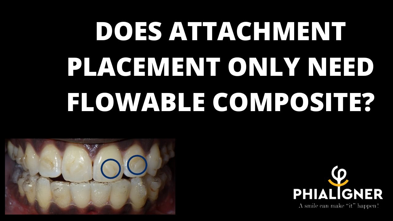 DOSE ATTACHMENT PLACEMENT ONLY NEED FLOWABLE COMPOSITE? - YouTube