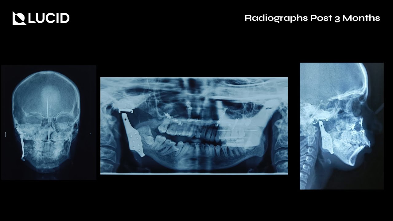 Maxilla LeFort 1 and Unilateral TMJ Resection & Reconstruction with PSI ...