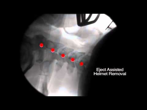 Eject Helmet Removal X-Ray (comparison markers) - YouTube