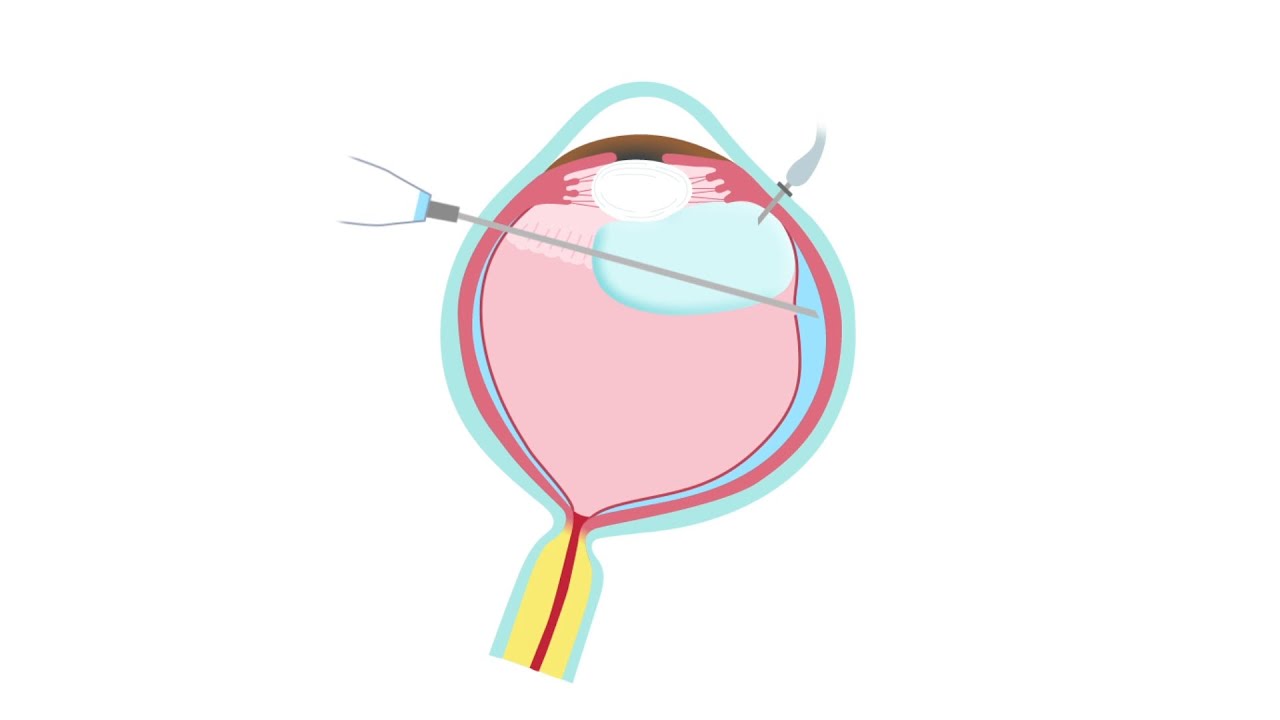 Retinal Detachment Treatment—Pars Plana Vitrectomy - YouTube