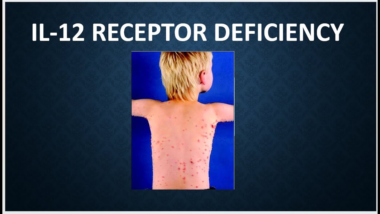 IL 12 receptor deficiency - Immunology USMLE Step 1 - YouTube
