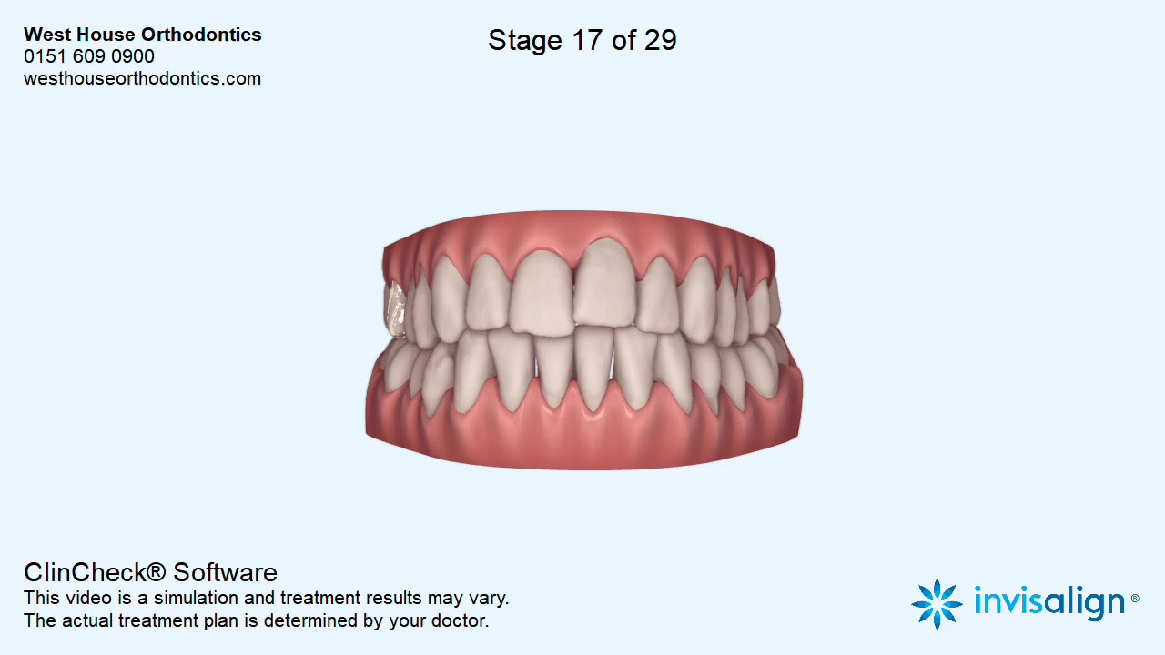 Invisalign Full case number 3 - YouTube