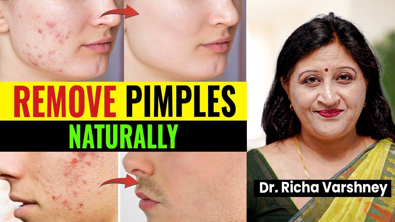 Pimples Treatment | How to get rid of small Pimples on face | Acne Home ...