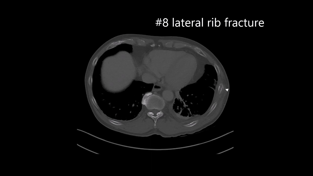 Echo-guided localization for posterolateral rib fractures - YouTube