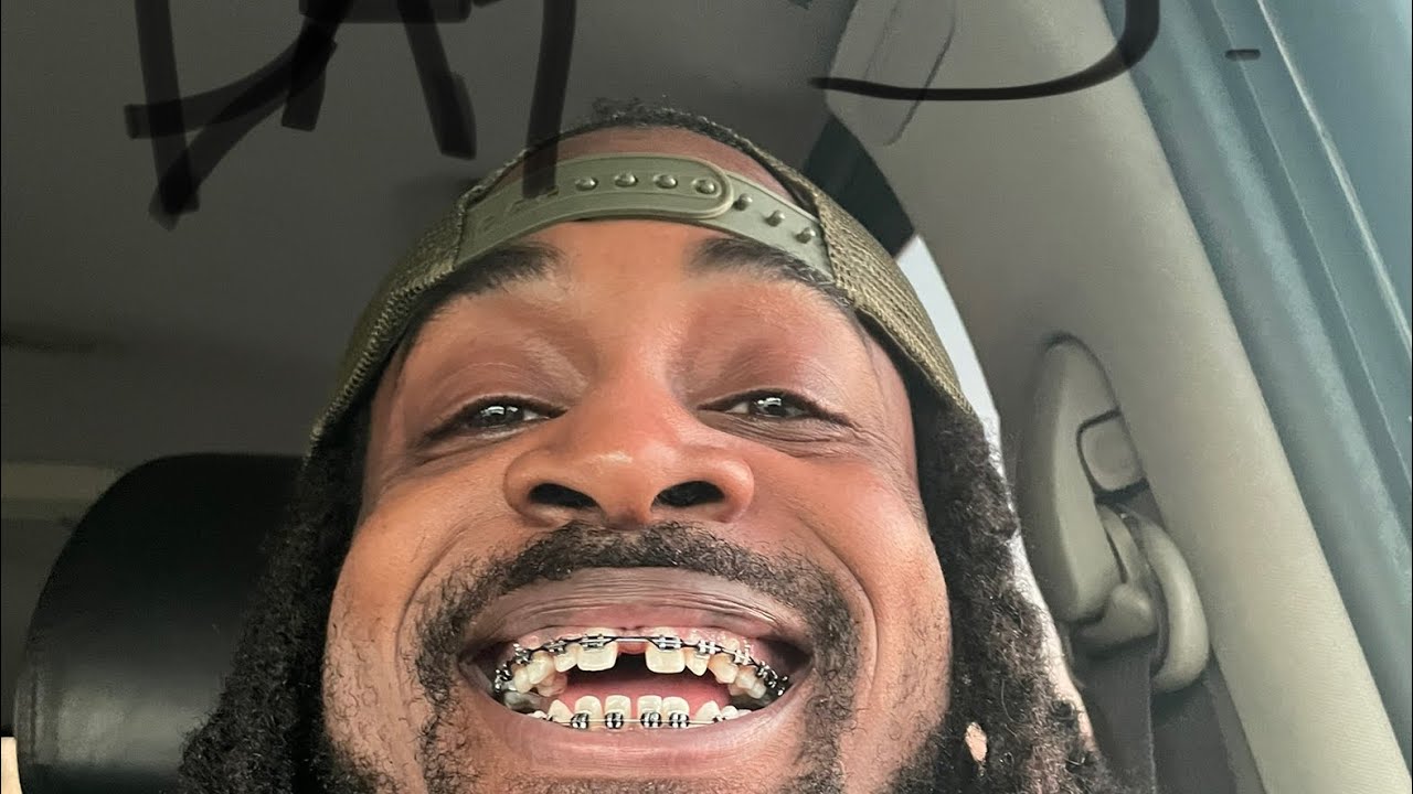 Day 5 update with power train for braces and a rant again lol men plz ...