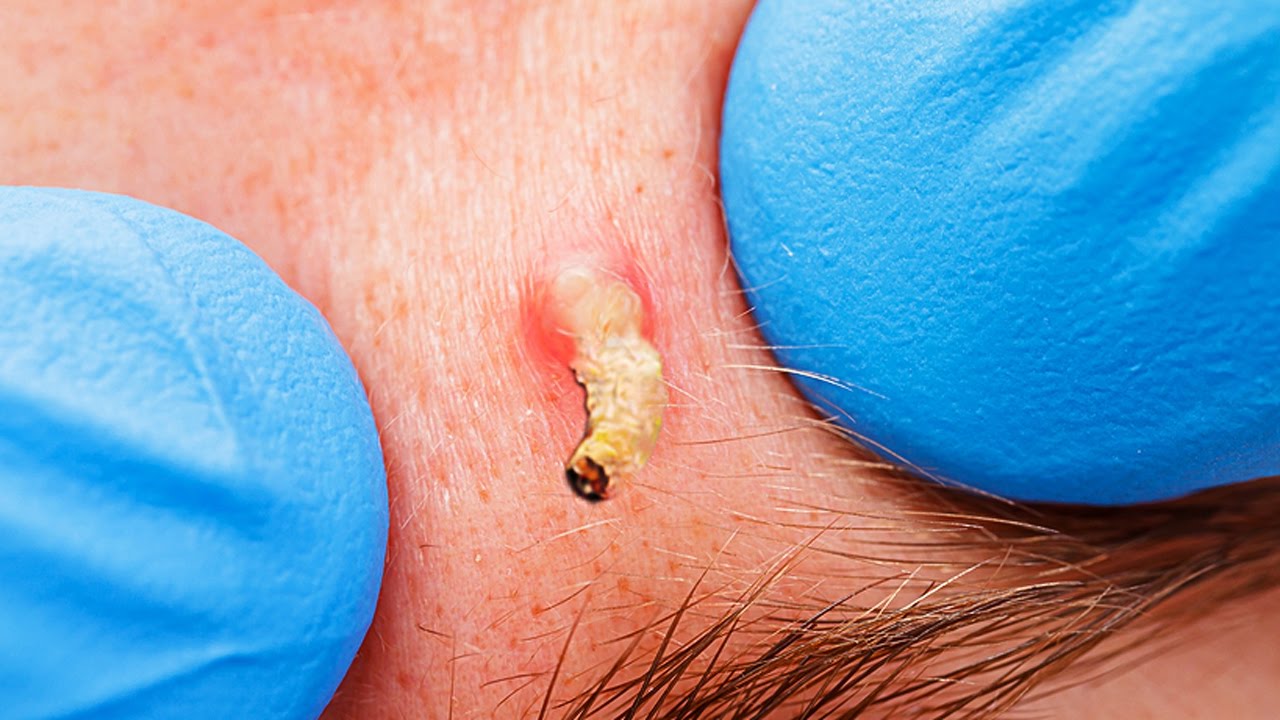 Dilated Pore of Winer vs Macro Comedones - YouTube