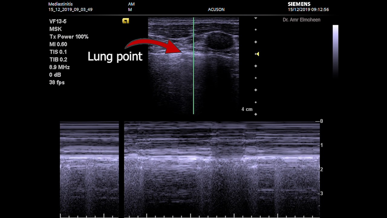 Lung Point, Seashore, Barcode sign (POCUS confirmed Pneumothorax) - YouTube