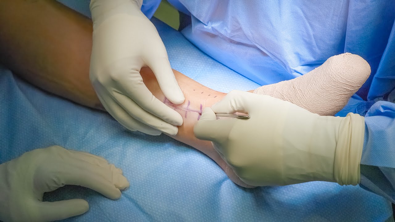 Operative Repair of Supination Adduction Ankle Fracture - YouTube
