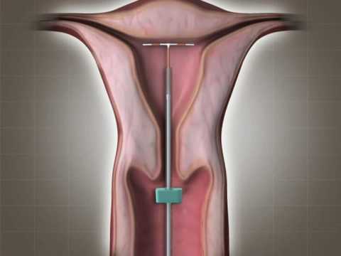 CopperT Insertion Animation