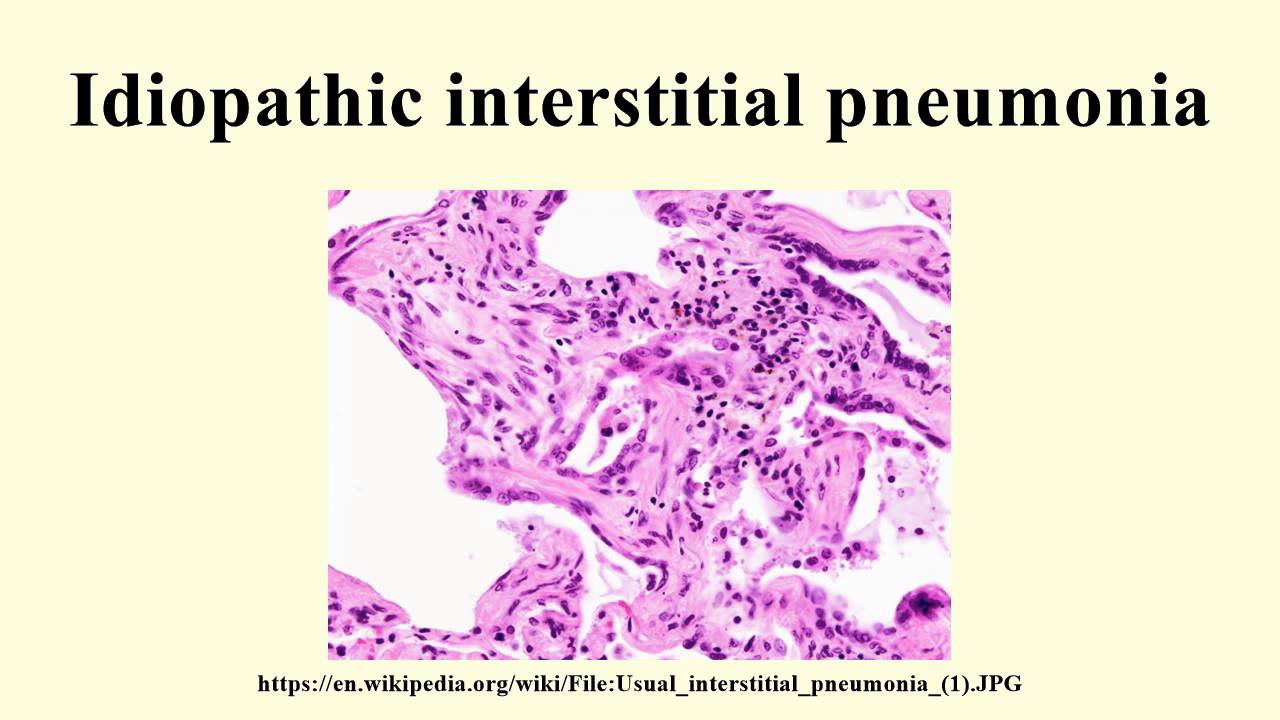 Idiopathic interstitial pneumonia - YouTube