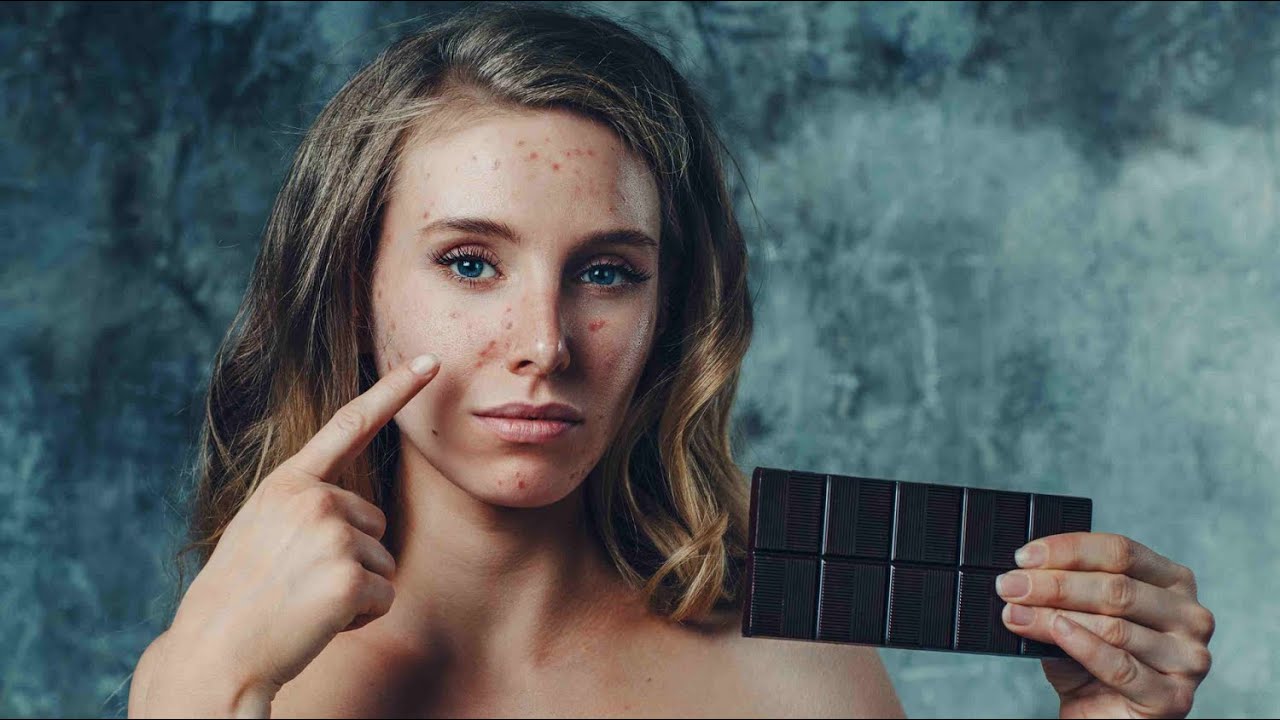 Chocolate Allergy in Adults: Symptoms, Causes, and Effective Treatments ...