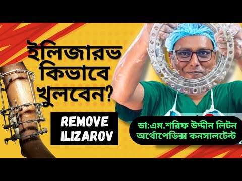 Removal of Ilizarov | ইলিজারভ কিভাবে খুলবেন | Ilizarov | Dr.M.Sharif Uddin Liton - YouTube