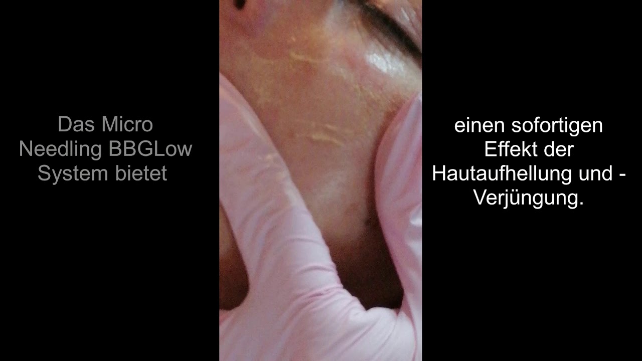 BB Glow Micro Needling - YouTube