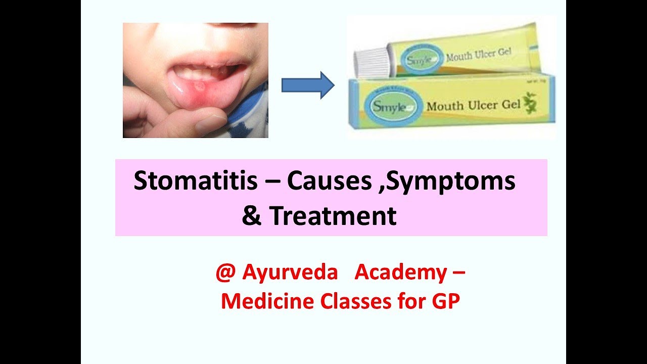 Apthous ulcer l stomatitis vs Traumatic Ulcer l canker sore l Recurrent ...
