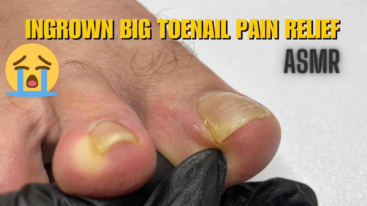 ingrown big toenail pain relief 😭 | pedicure cleaning | pedicure asmr ...