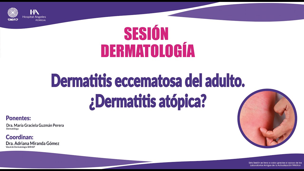 Dermatitis eccematosa del adulto. ¿Dermatitis atópica? - YouTube