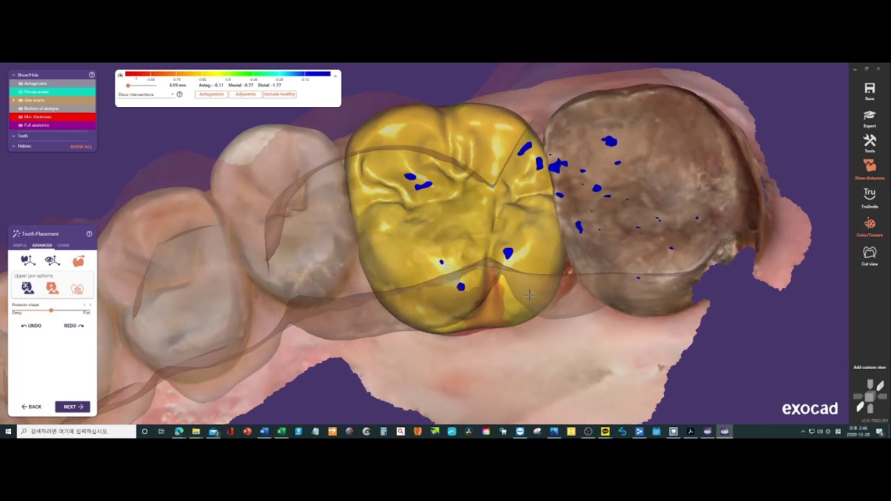 exocad 3.0 crown design - YouTube