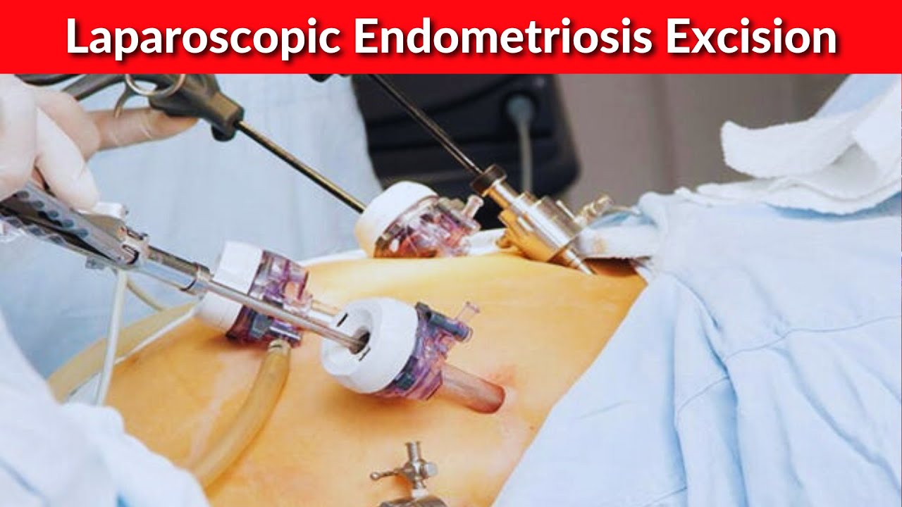 Laparoscopic Endometriosis Excision Video | Dr Kunal Rathod - YouTube
