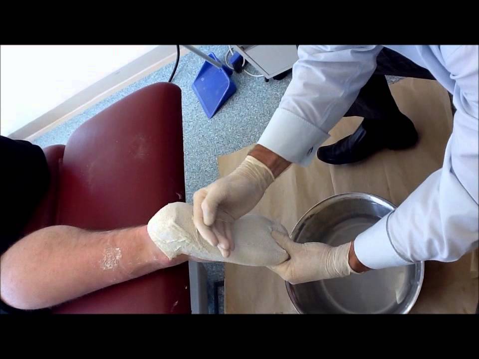 Stewart Hayes, Sports Podiatrist - Negative Casting Technique - YouTube