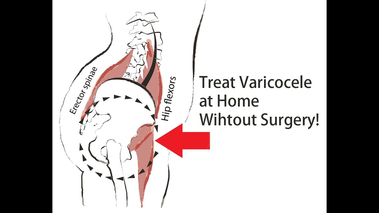 Varicocele - Surgery vs. Lifestyle! - YouTube