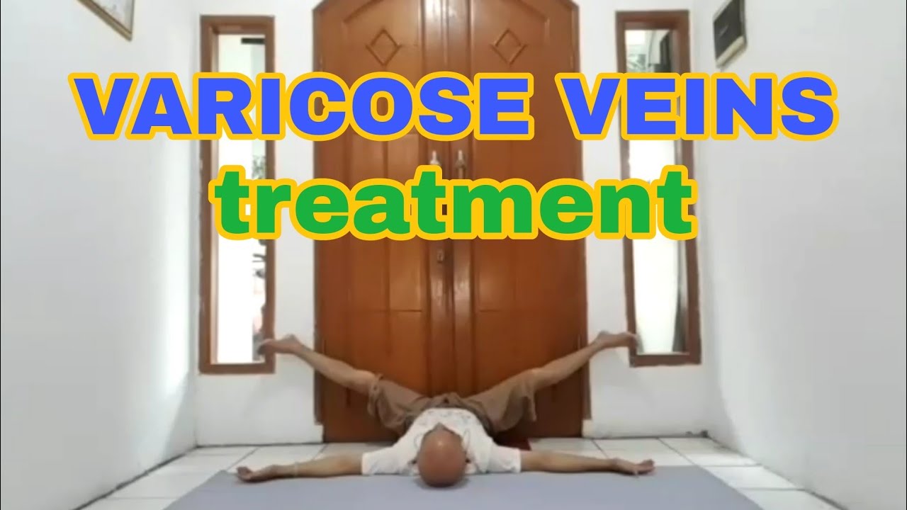 apakah varises bisa dihilangkan? lakukan gerakan mudah ini - YouTube