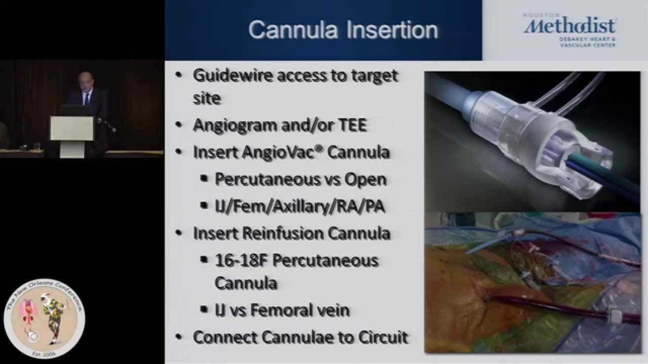 Use of the AngioDynamics AngioVac - YouTube