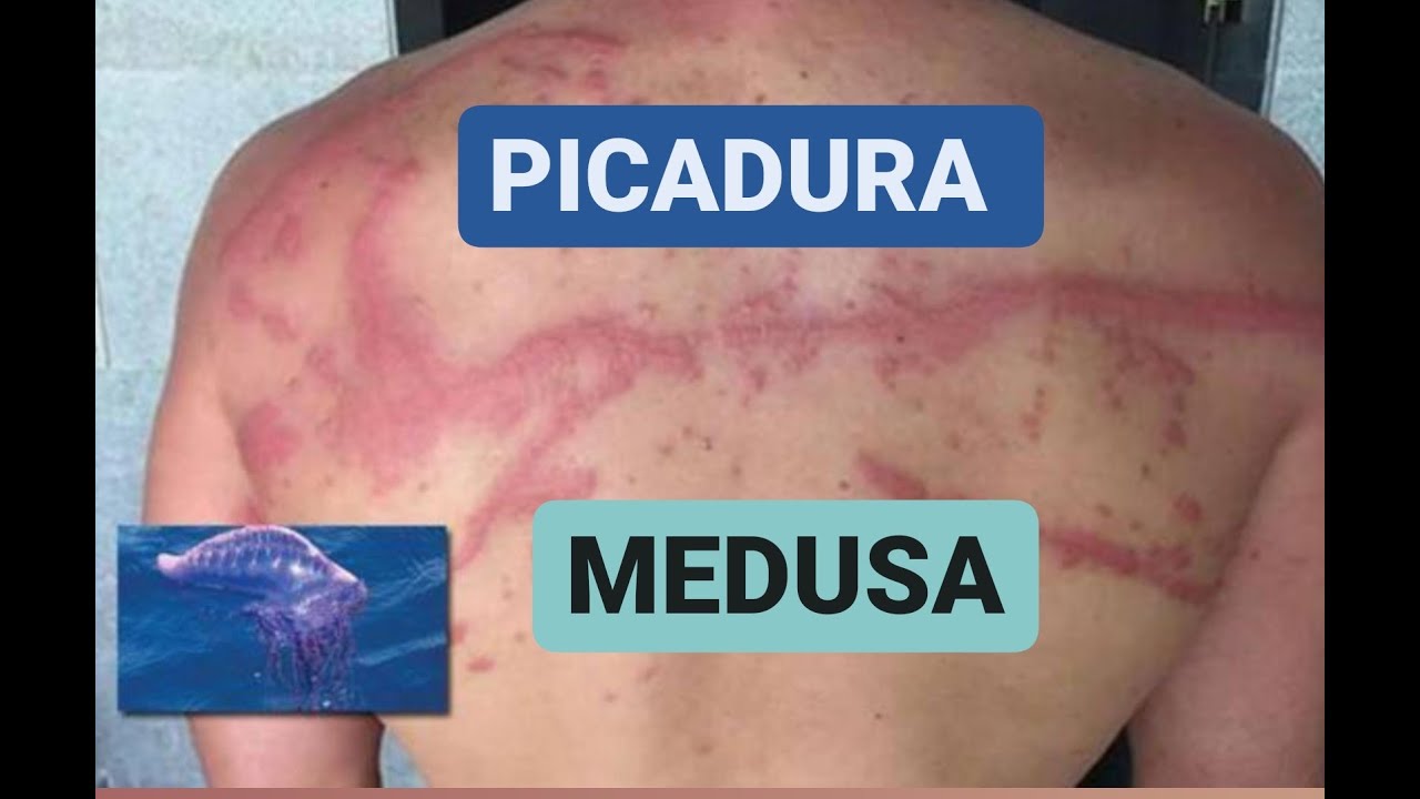 Picadura de MEDUSA - YouTube