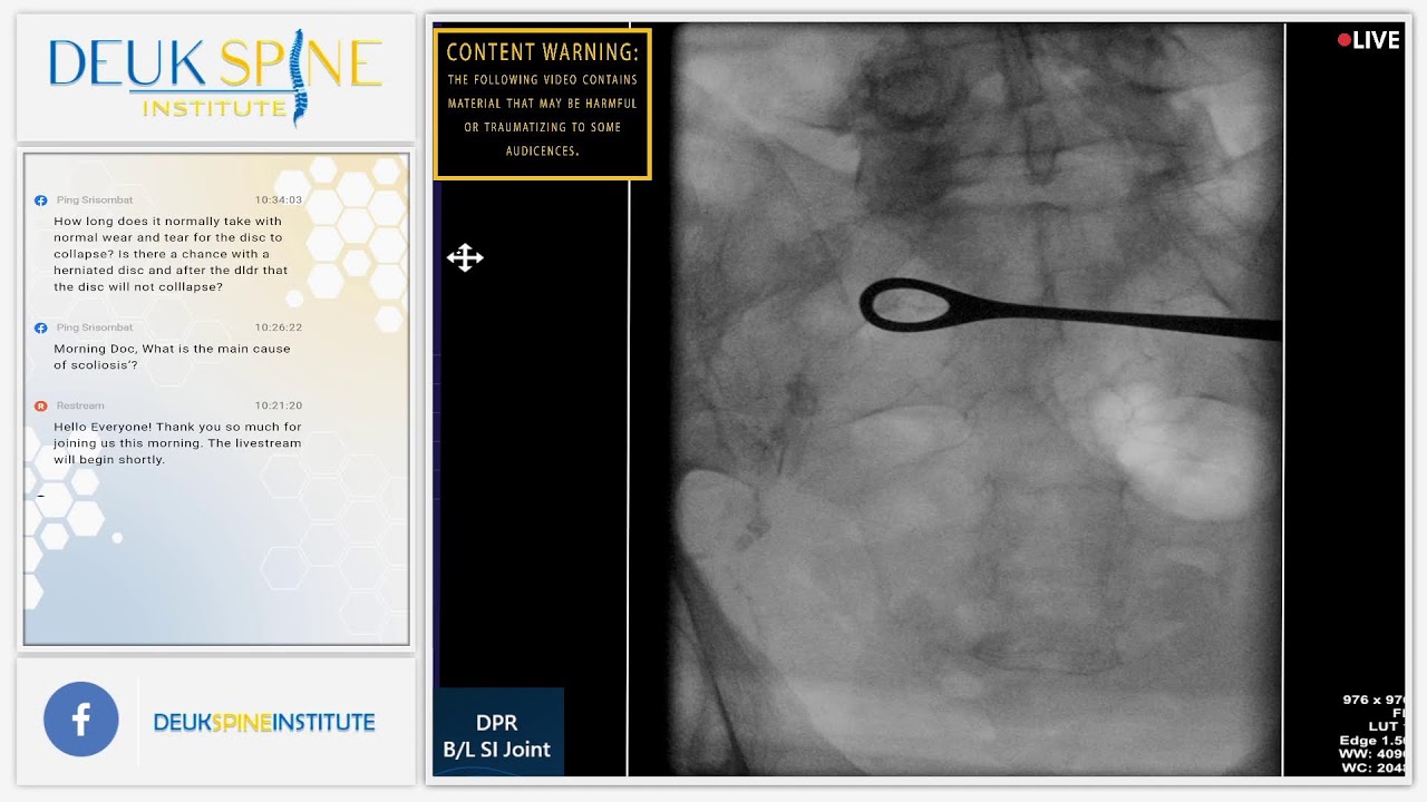 Laser Spine Surgery for Discogenic Lower Back Pain from Herniated Disc ...