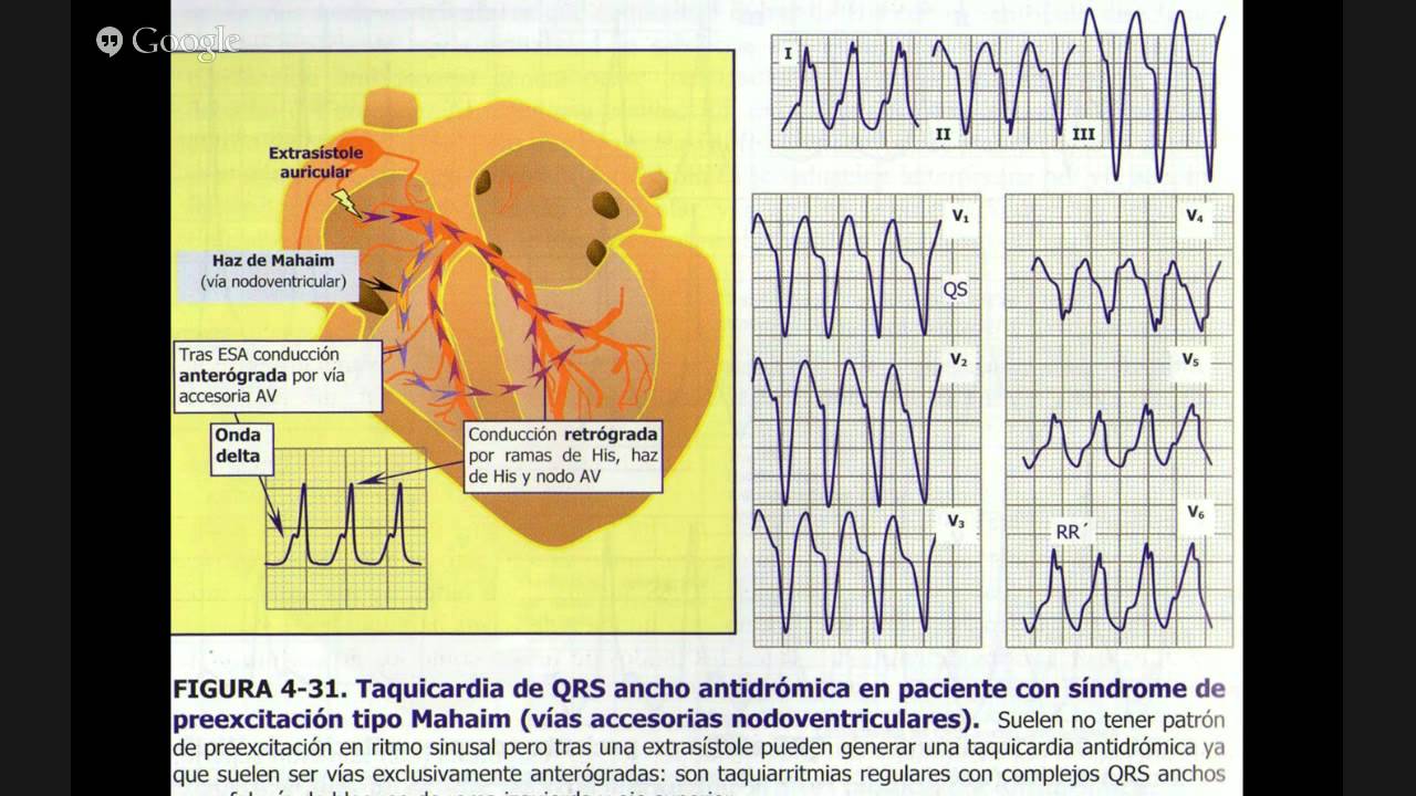 TAQUIARRITMIAS DE QRS ANCHO - YouTube