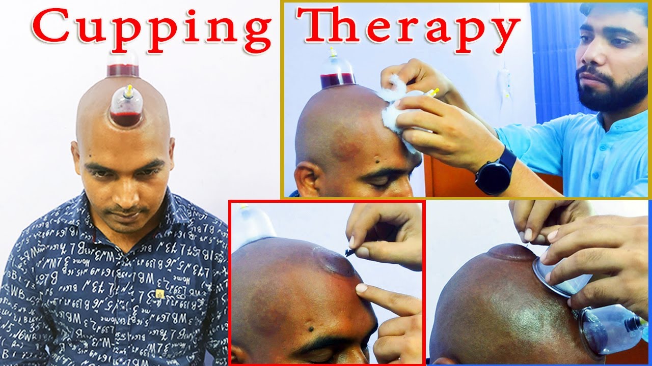 Cupping Therapy Second Session | Hijama therapy | hijama treatment for ...