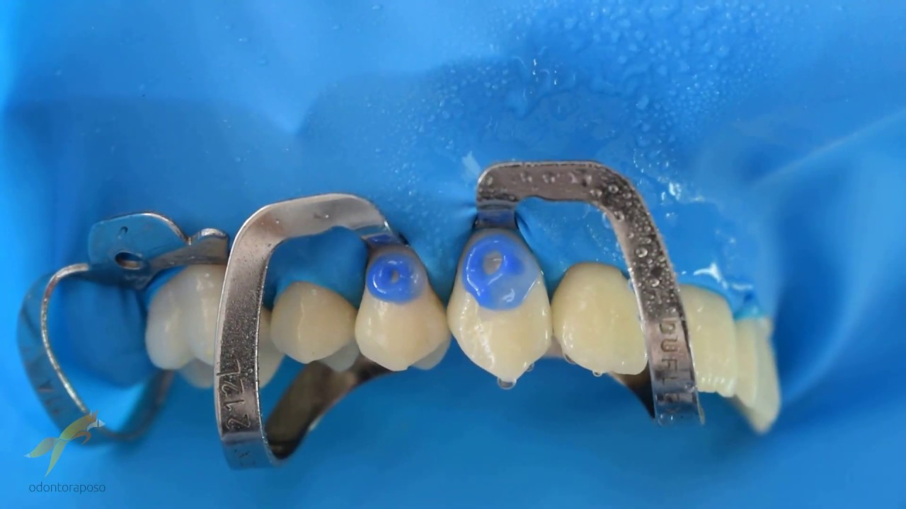 CLASSE 5 - Resina Composta - YouTube