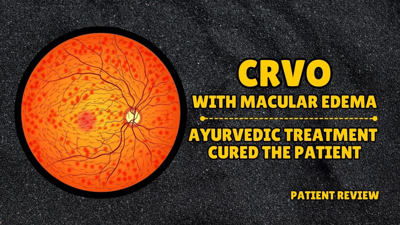 CRVO with Macular edema- cured with Ayurveda treatments - YouTube