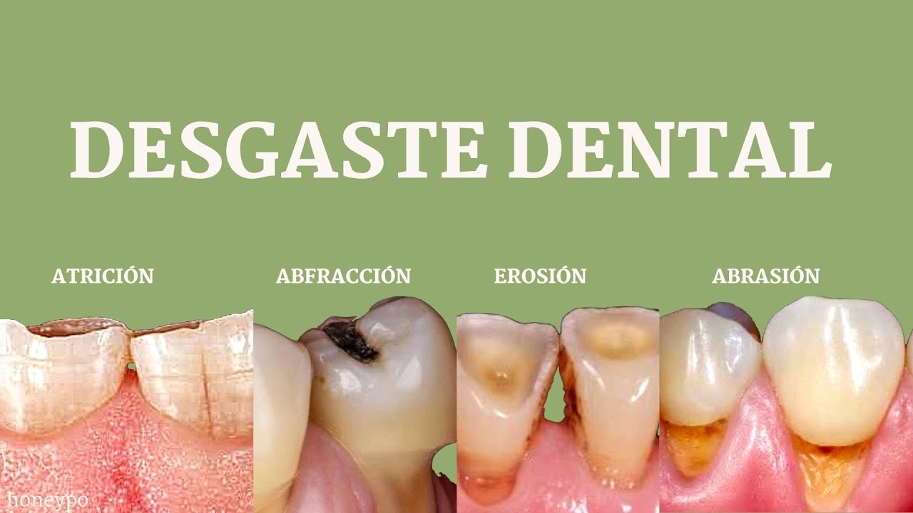 Desgaste dental : atrición, abfracción , erosión y abrasión - YouTube