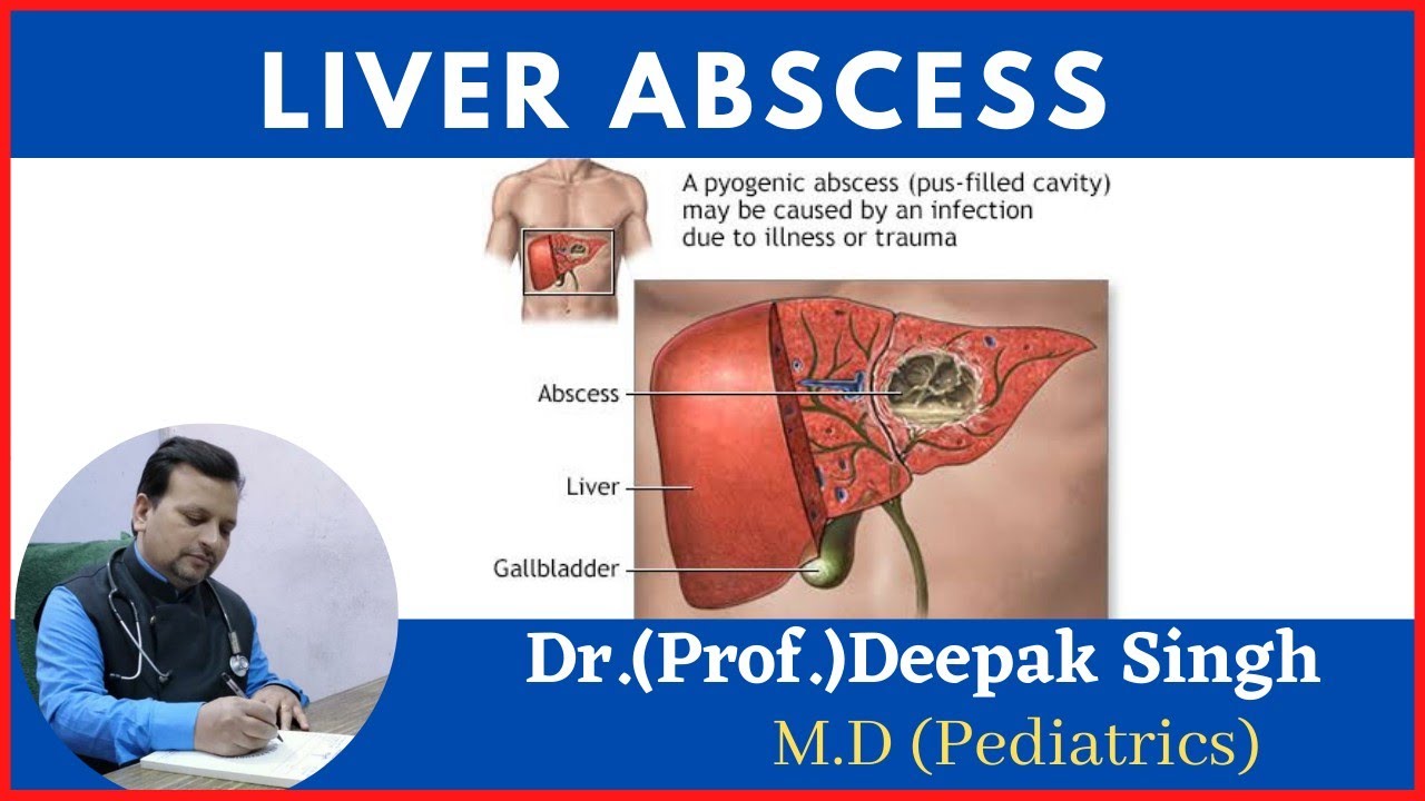 liver abscess # Hepatic abscess # Amoebic abscess # Deepak PD. Singh ...