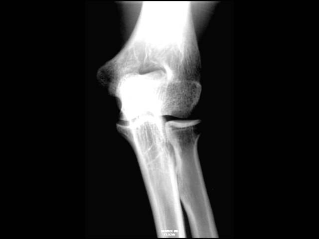 Xray Elbow Fractured Neck Of Radius | Image | Radiopaedia.org