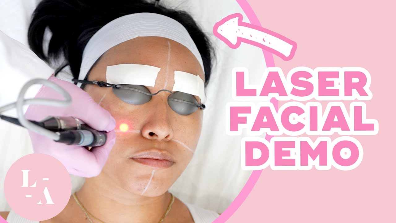 Lasers Did What to Her Face?! | Laser Facial Demo - YouTube