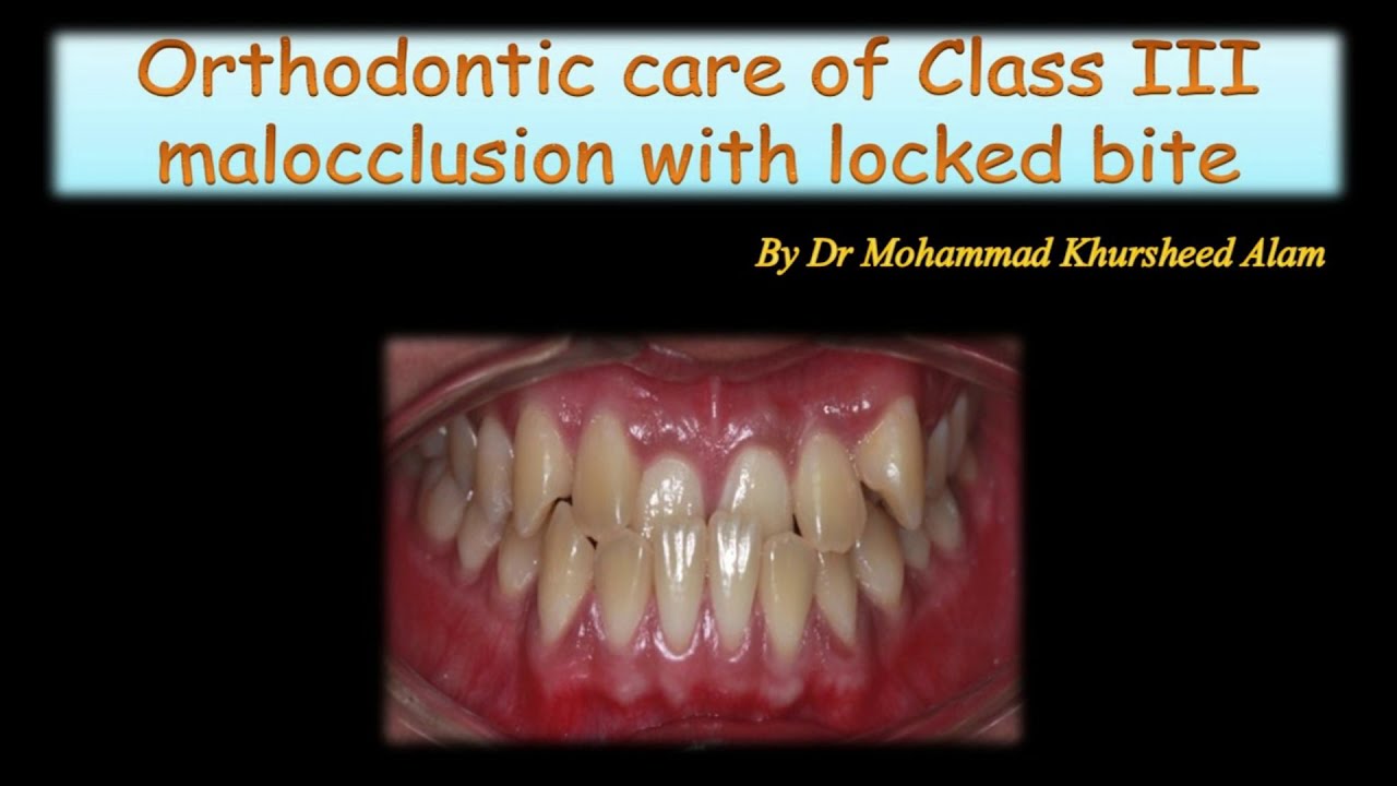 Orthodontic care of class III malocclusion with locked bite - YouTube