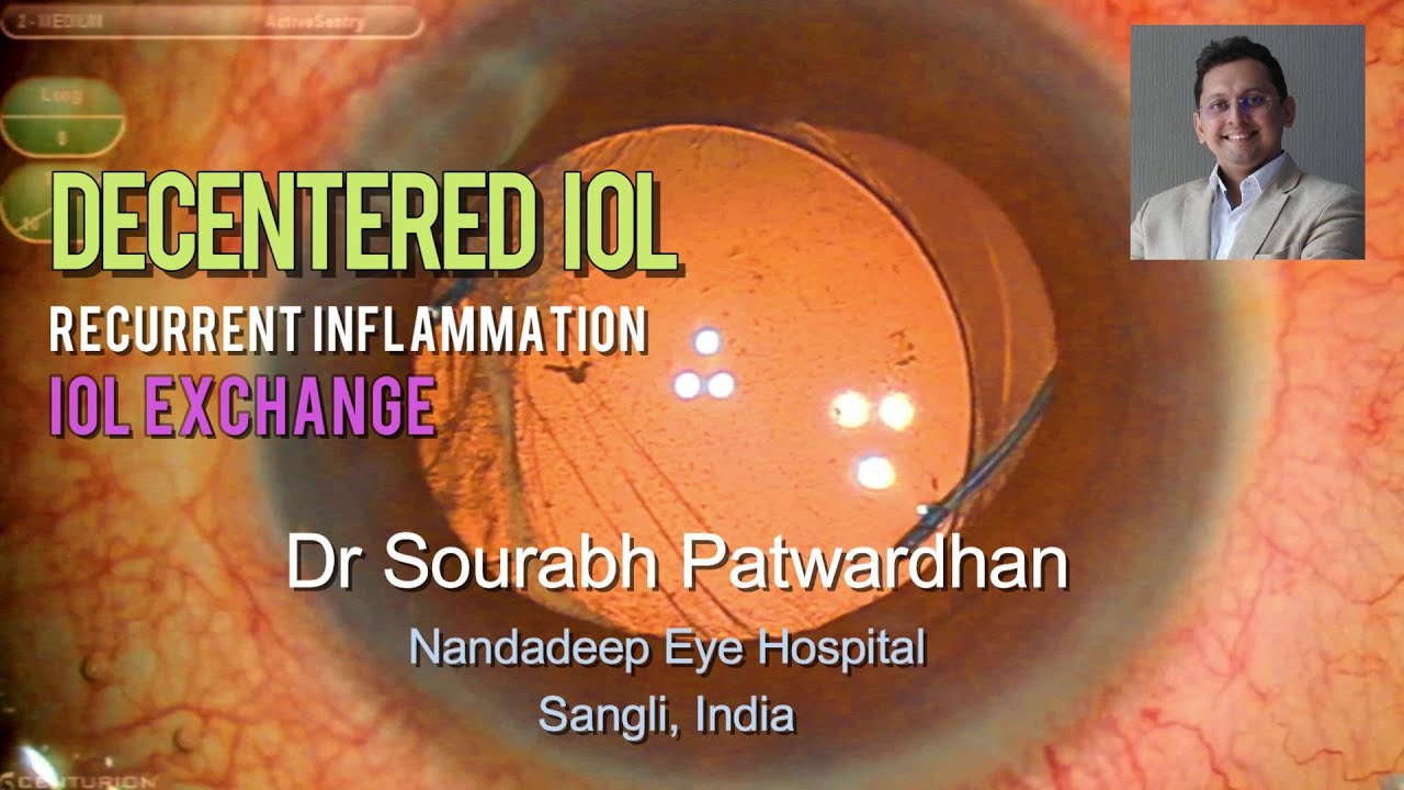 244 IOL exchange: why 3 piece IOL was causing inflammation Dr Sourabh ...