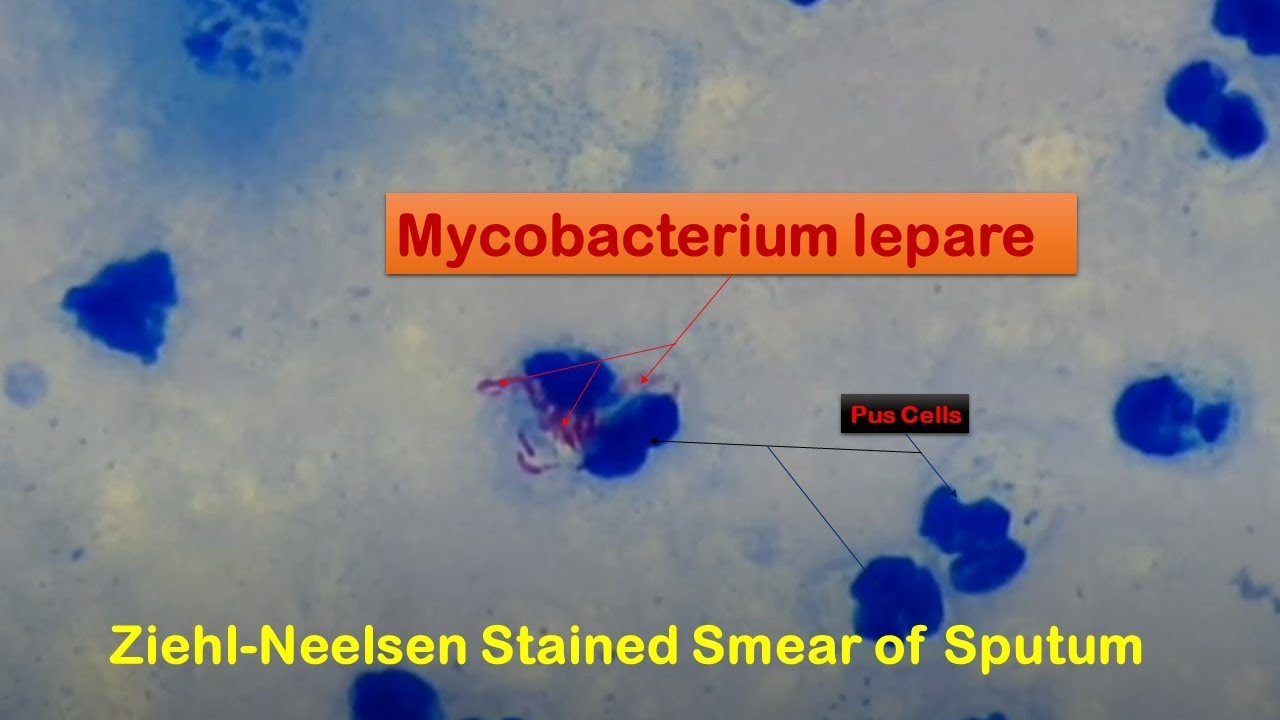 Sputum in Ziehl-Neelsen in staining showing Mycobacterium leprae - YouTube