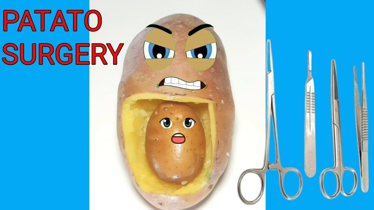 PATATO GIVES A BABY!NED EMERGENCY SURGERY/FOOD SURGERY#sikder# ...