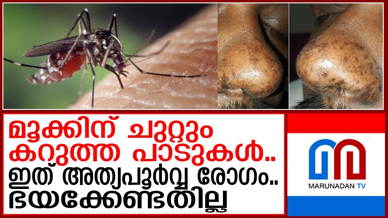 ഒരു അപൂർവ രോഗത്തെ കണ്ടെത്തിയതായി വിദഗ്ധർ | Chik sign in chikungunya ...