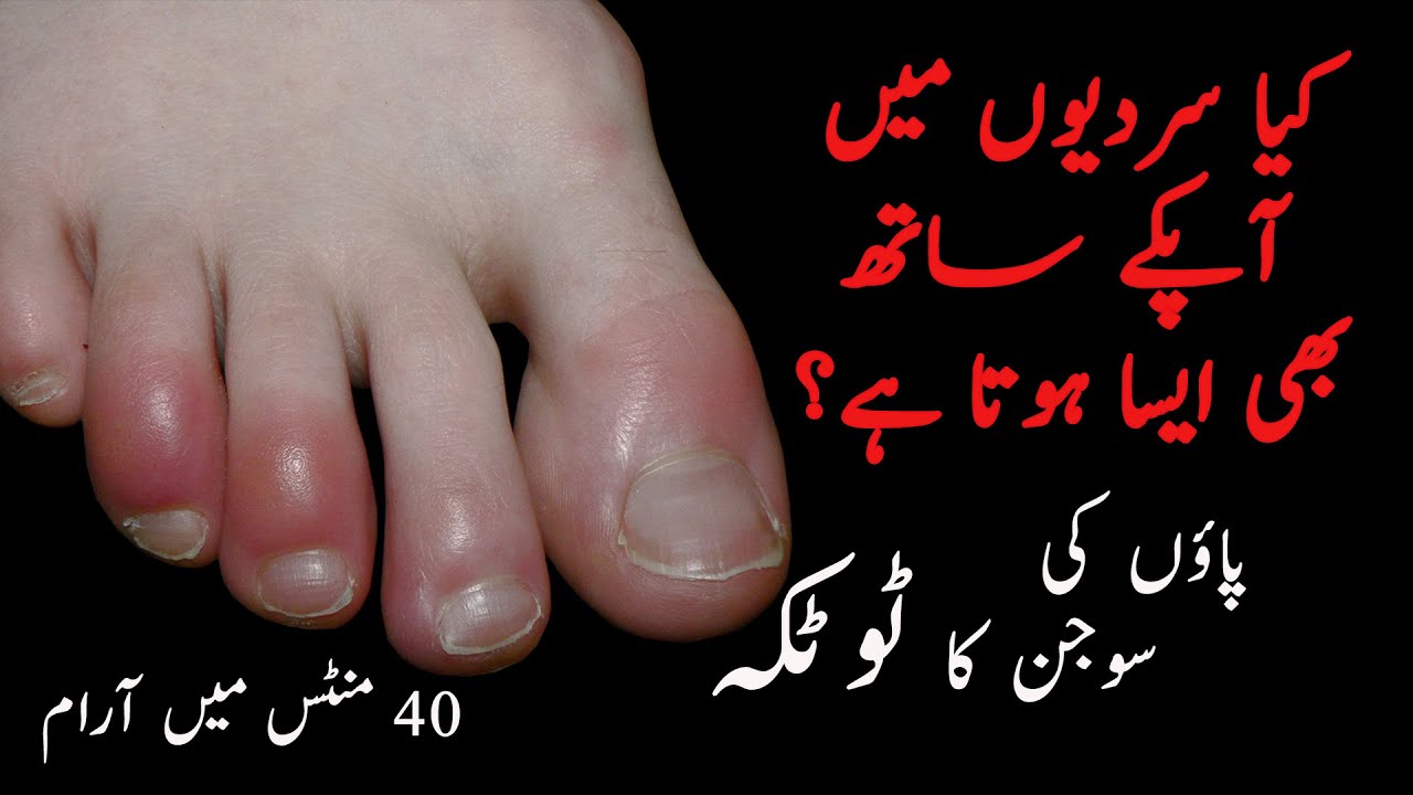 How to Treat Swollen Fingers of Foot? Treatment of Chilblains on Foot ...