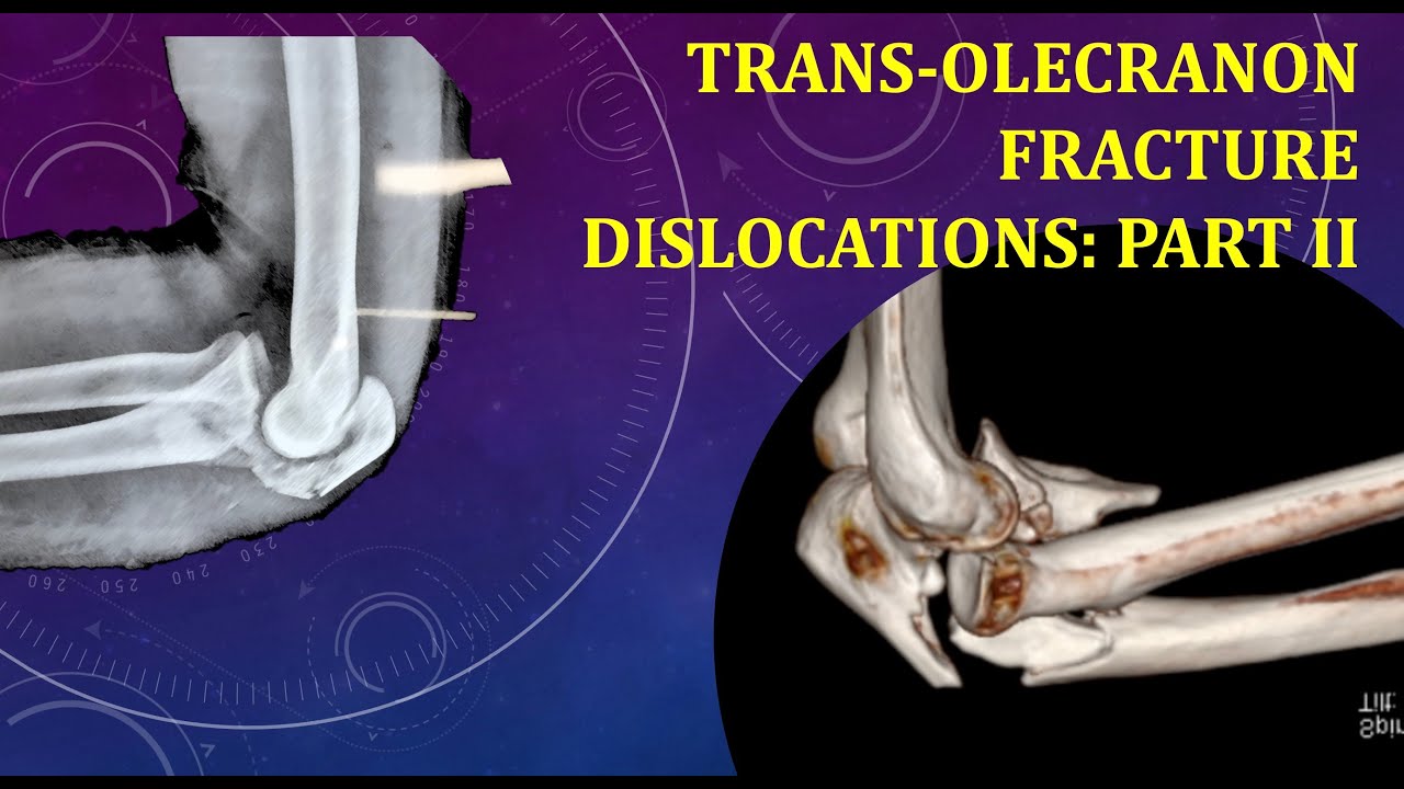 TRANS-OLECRANON FRACTURE DISLOCATIONS PART II (GRAPHIC) - YouTube